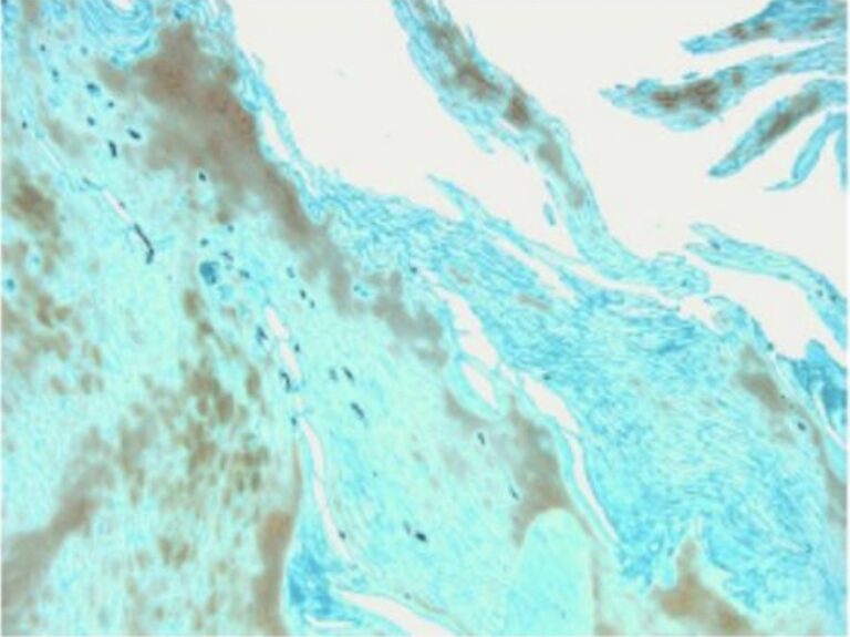 NAIL FUNGAL INFECTION TESTING | ALLIANCE™ Laboratories